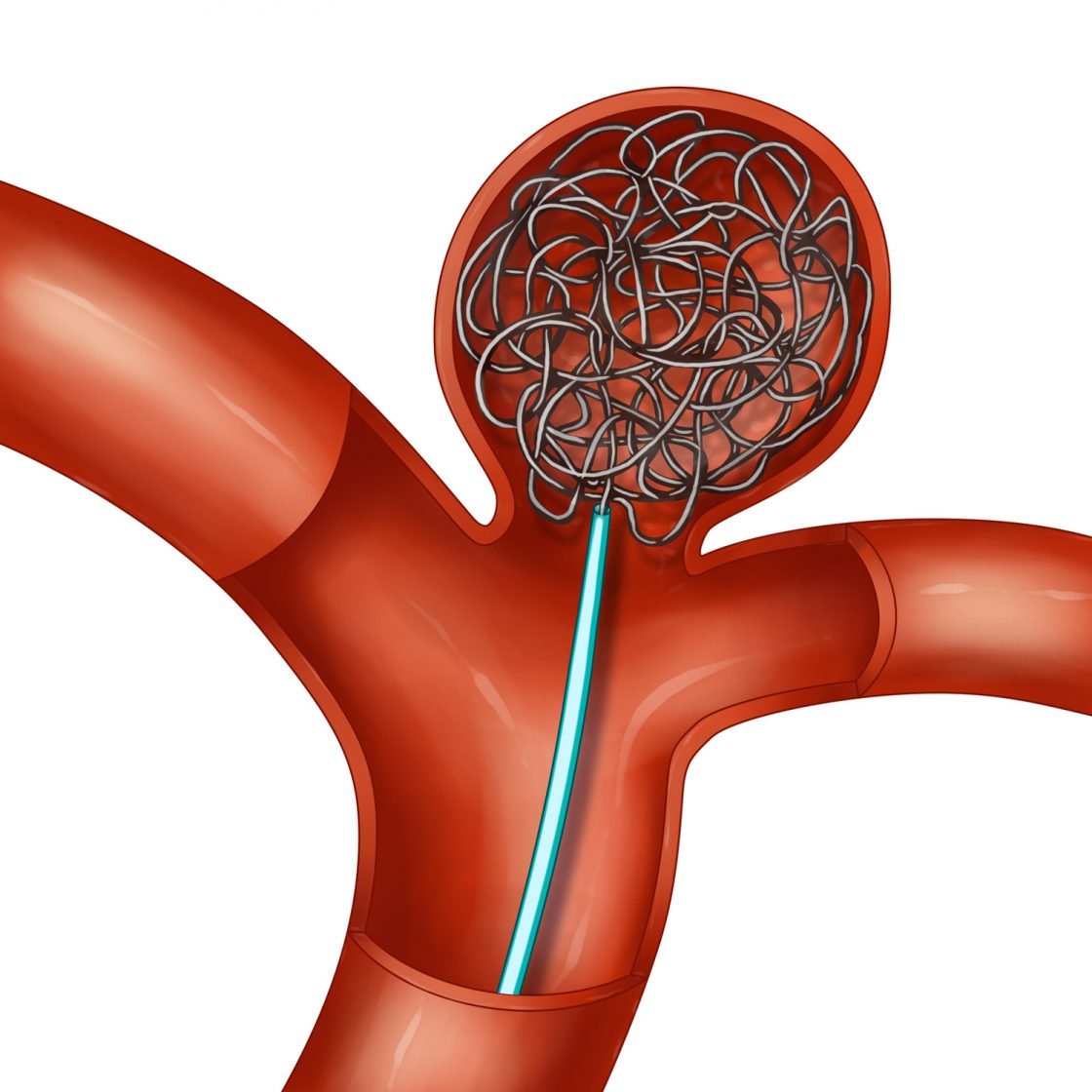 Cerebral Aneurysm - Toronto Neurovascular Group