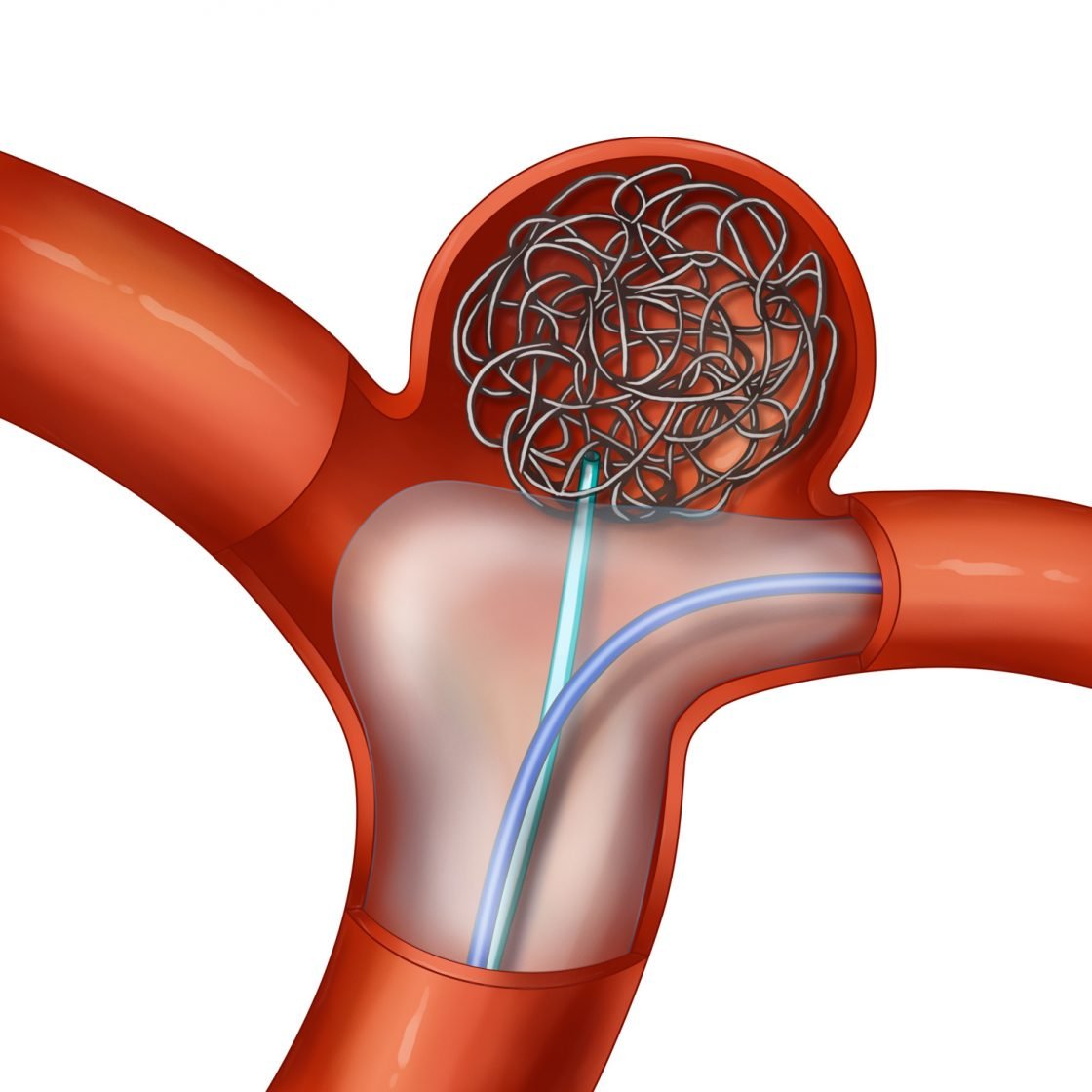 Cerebral Aneurysm - Toronto Neurovascular Group