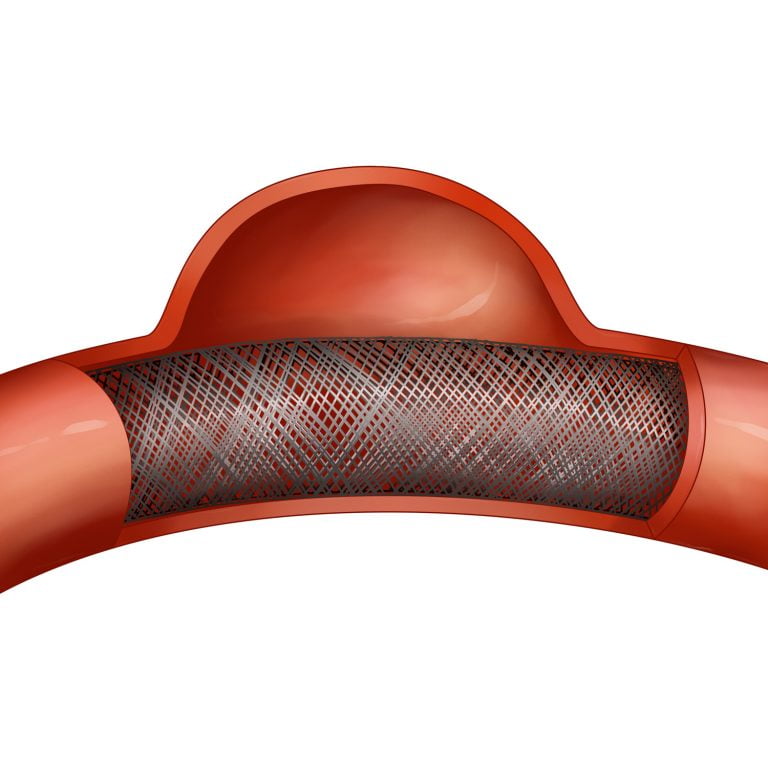 Cerebral Aneurysm - Toronto Neurovascular Group
