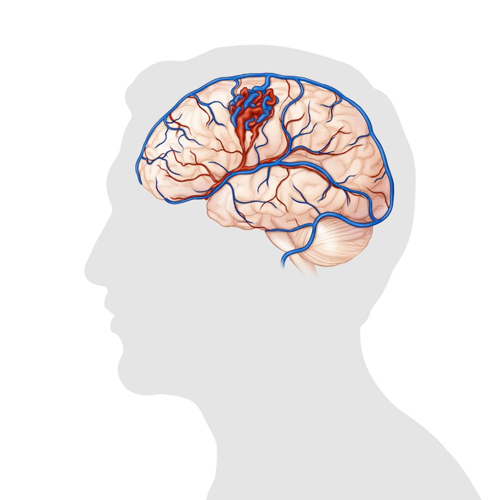Brain/Spine AVM - Toronto Neurovascular Group