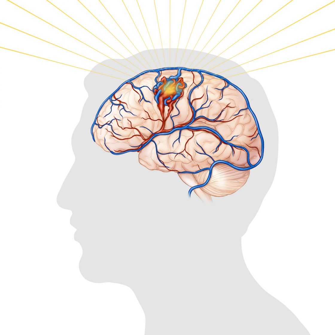 Brain/Spine AVM - Toronto Neurovascular Group