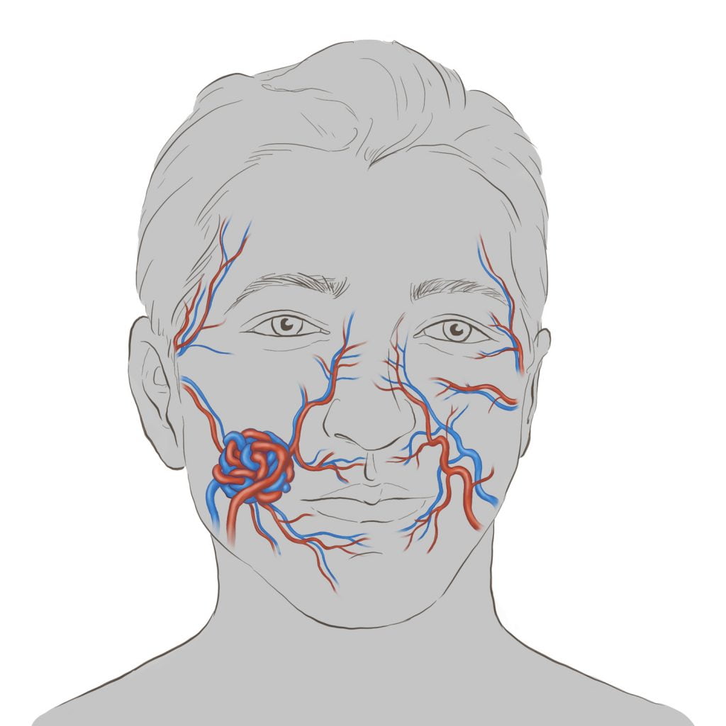 Facial Vascular Malformations / Venous Vascular Malformations - Toronto ...