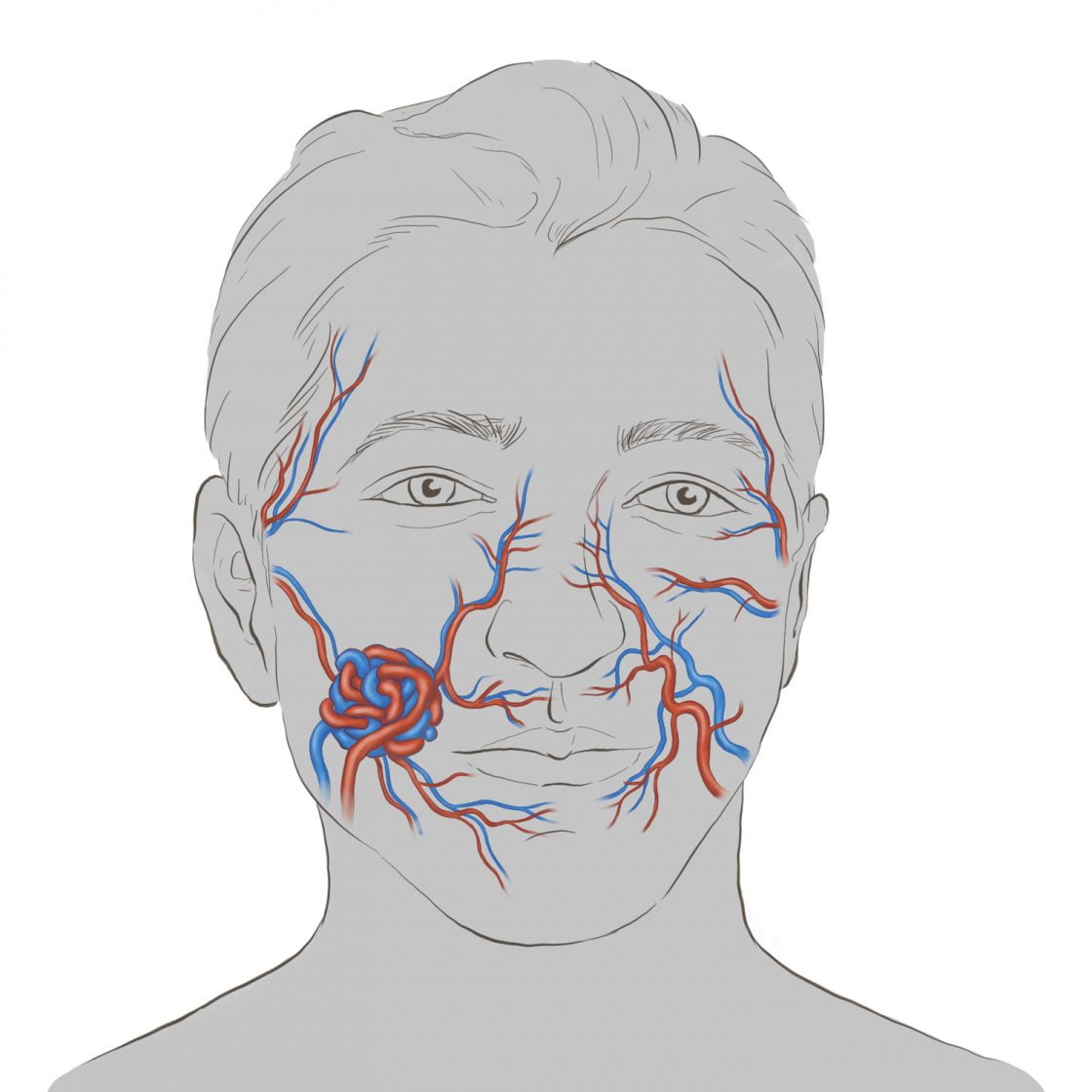 Facial Vascular Malformations / Venous Vascular Malformations - Toronto ...
