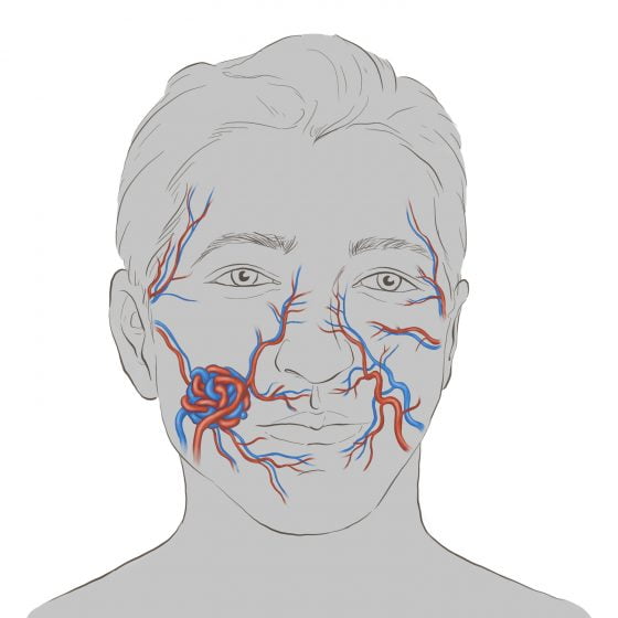 Facial Vascular Malformations / Venous Vascular Malformations - Toronto ...