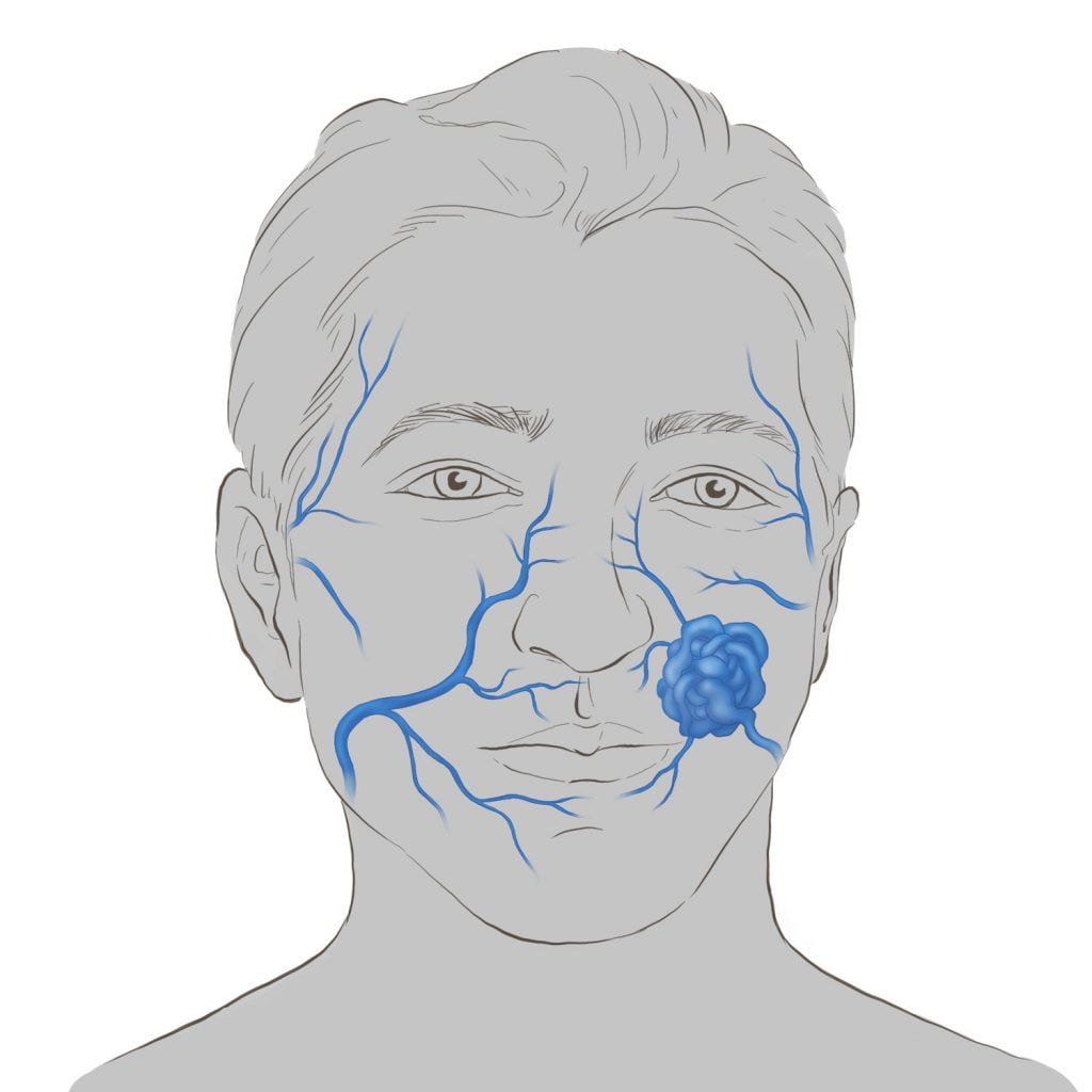 Facial Vascular Malformations / Venous Vascular Malformations - Toronto ...