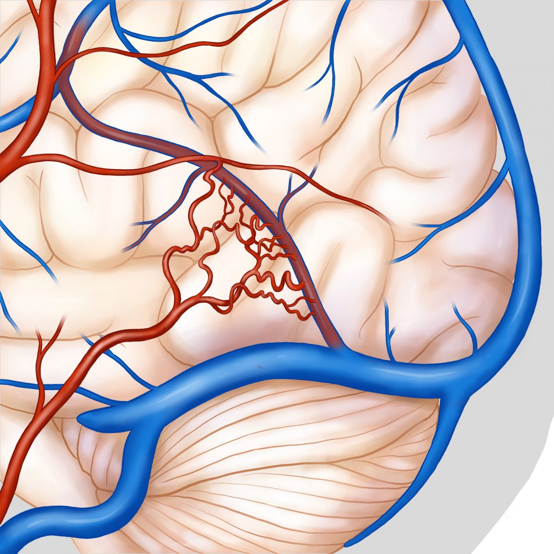 Dural Arteriovenous Fistula (dAVF) - Toronto Neurovascular Group