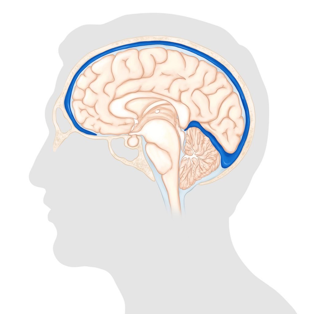 Intracranial Hypotension/CSF Leak - Toronto Neurovascular Group