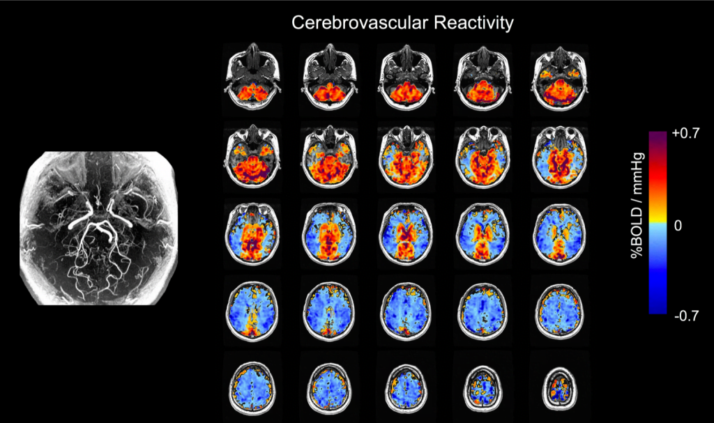 Research - Toronto Neurovascular Group