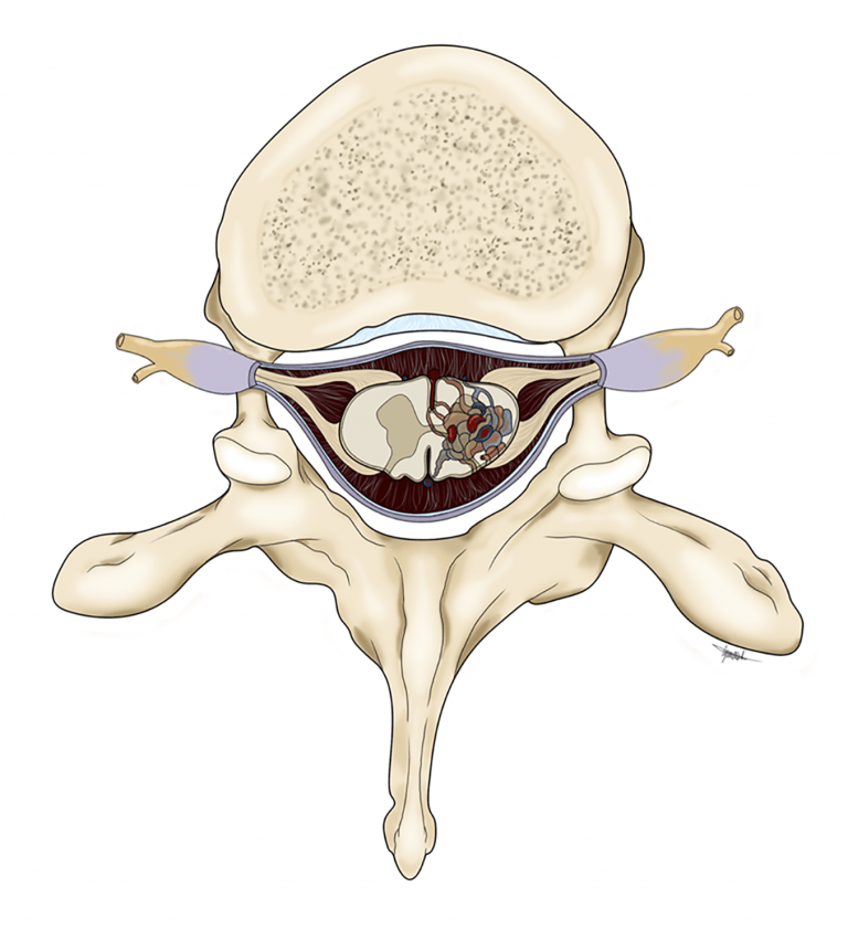 Brain/Spine AVM - Toronto Neurovascular Group