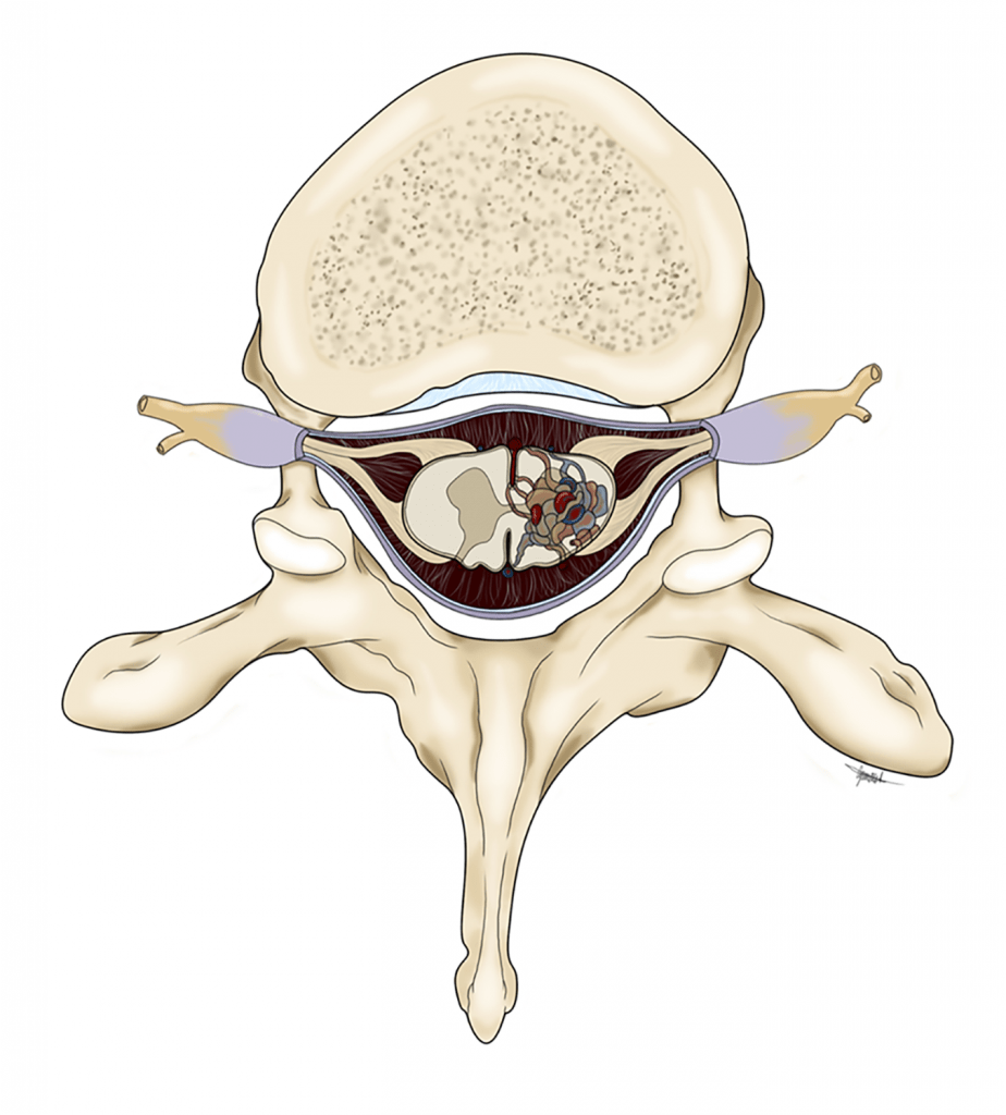 Brain/Spine AVM - Toronto Neurovascular Group