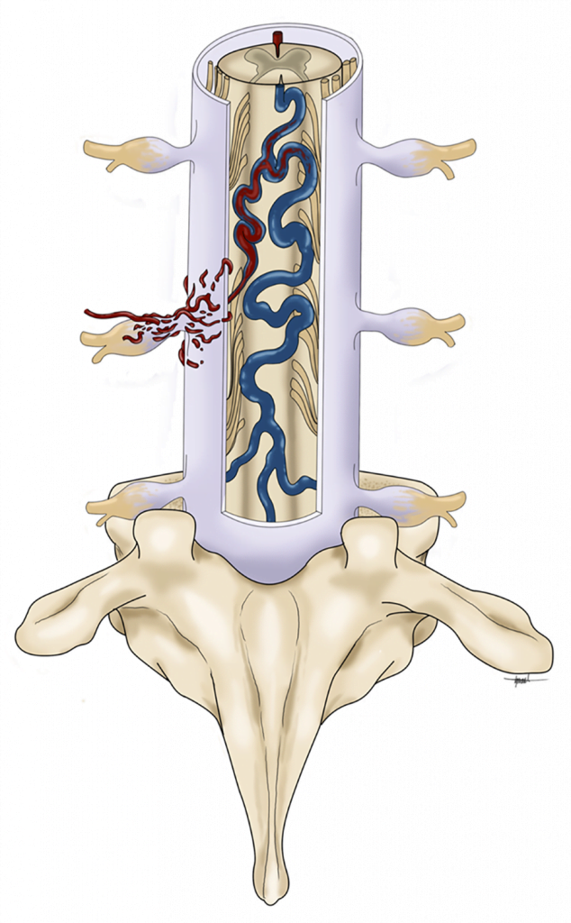 Brain/Spine AVM - Toronto Neurovascular Group